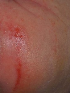 Wonderful Witch Hazel - Reasons This Herbal Remedy Should Be In Every ...