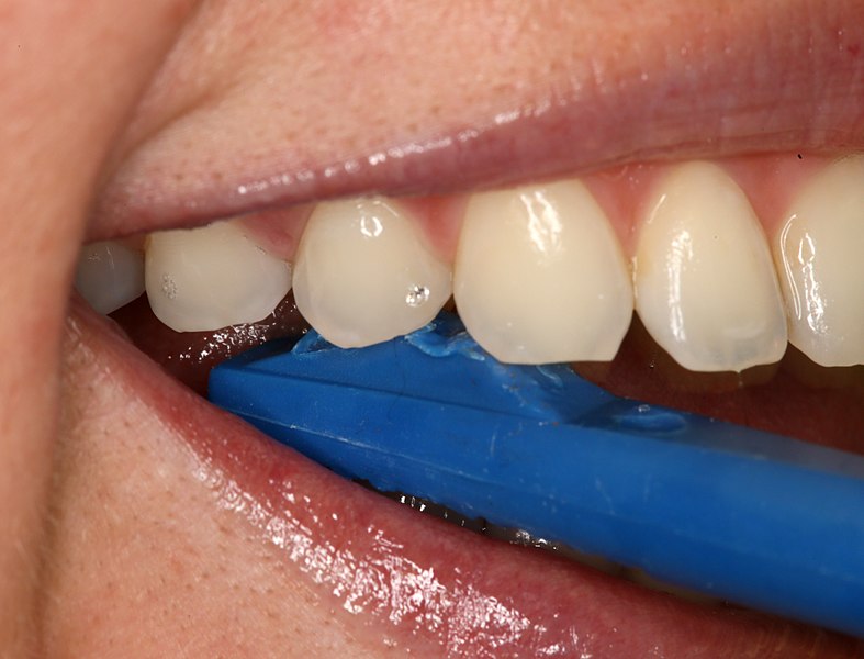 8 Natural Ways to Fight Cavities and Tooth Decay - Home and Gardening Ideas